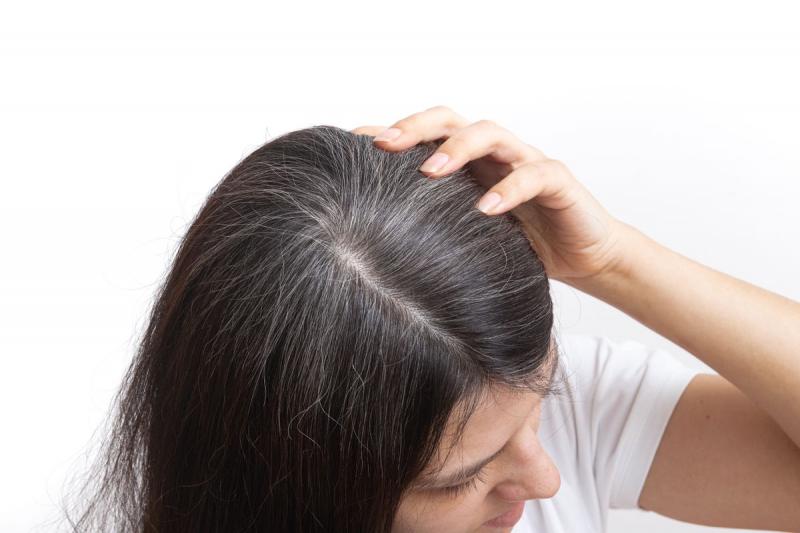 Mengapa Uban Bikin Kepala Gatal?